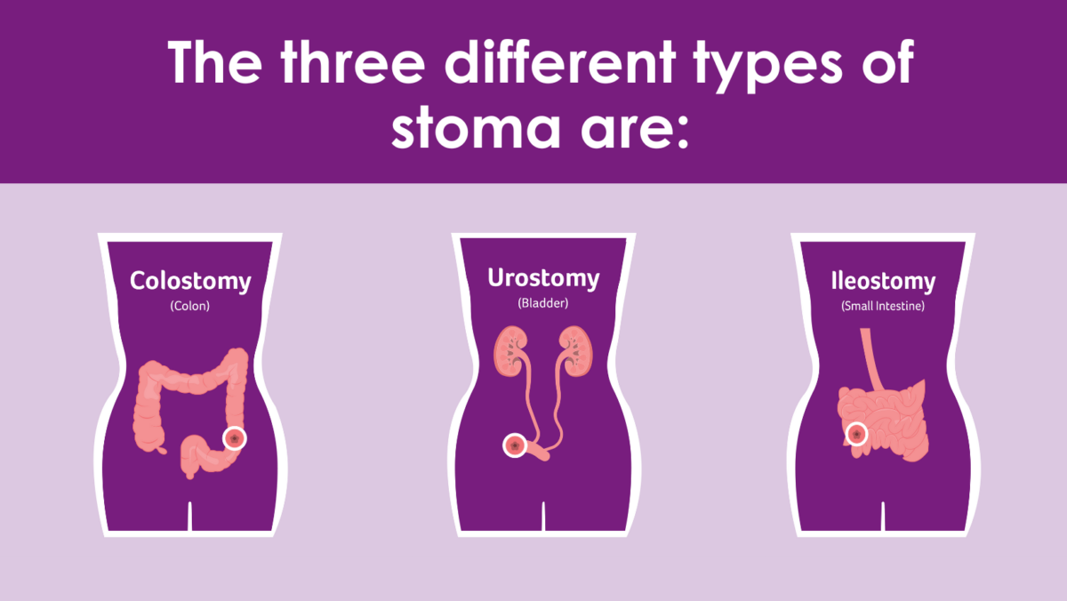 What is a stoma? - Colostomy UK - Supporting and empowering you